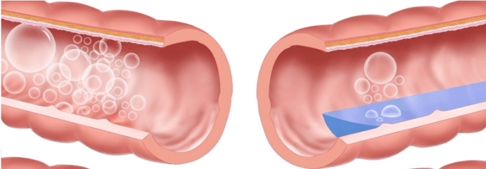 Understanding intestinal gas - Isomed Pharma - Inspiring Health